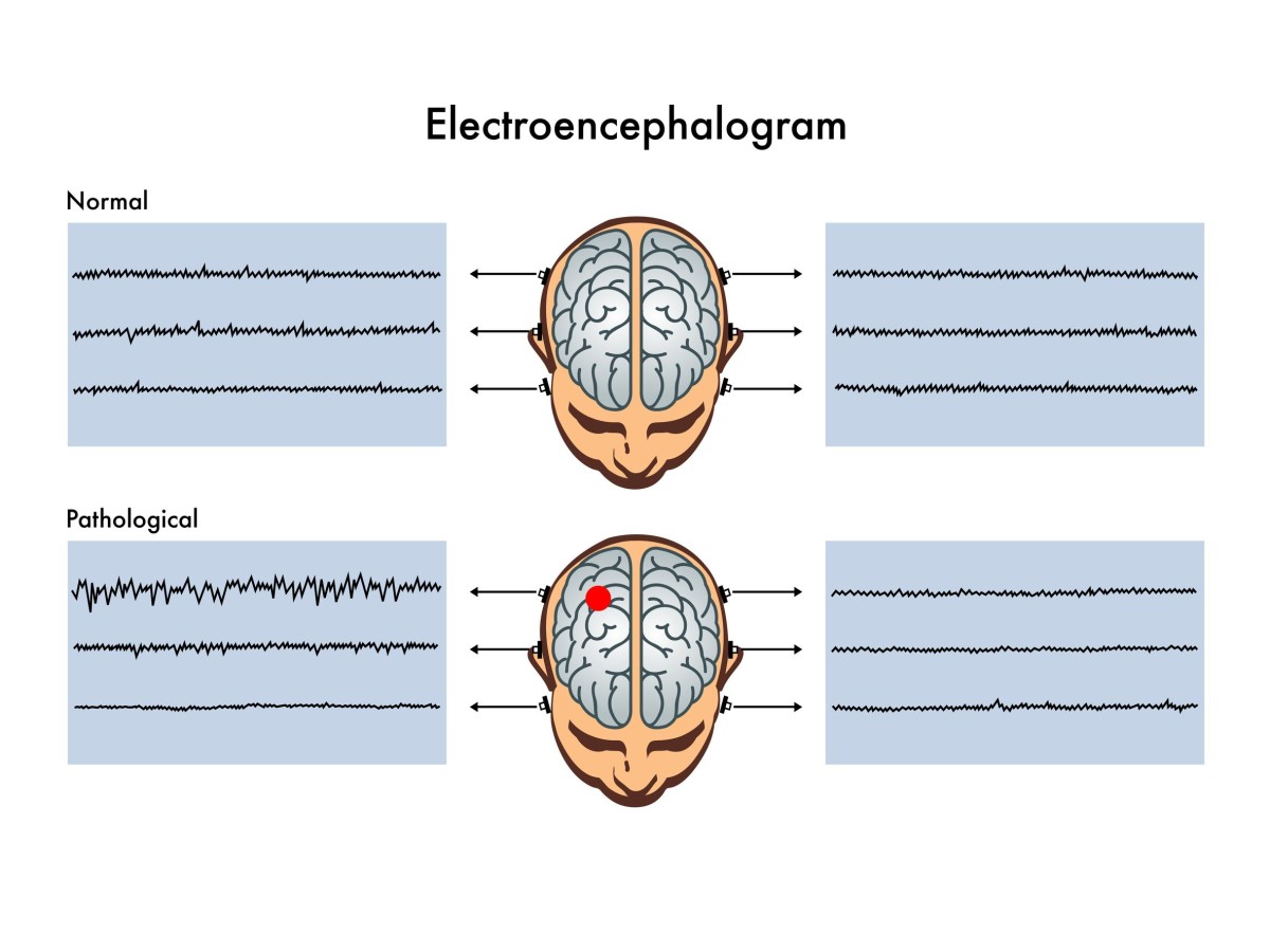 Electroencephalogram (EEG) - Dr. Raul Grosz
